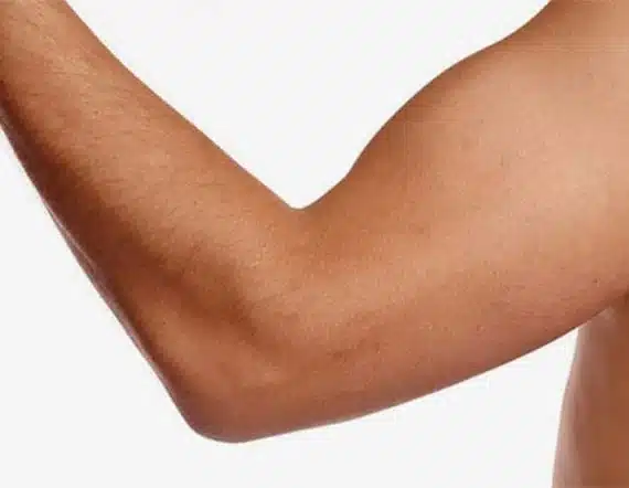 Cryotherapy for Keloids in Miami Beach, FL | Dr. Mendez