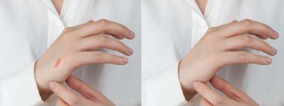 Benefits of Cryotherapy for Keloids and Scar Tissue | Miami, FL
