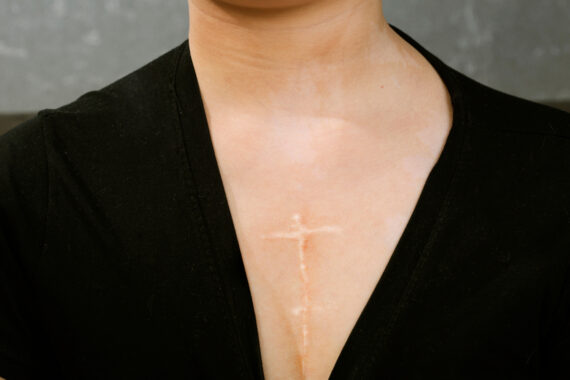 Open Heart Surgery Scar Healing: How to care scars | Miami, FL Open Heart Surgery Scar Healing: How to care scars | Miami, FL