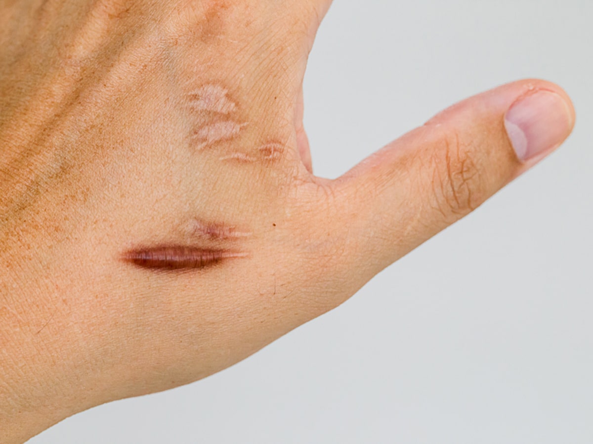 Treating Keloids: Radiation Therapy and Surgery | Miami, FL