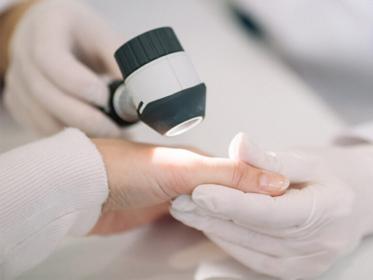 Cryotherapy for Keloids in Miami Beach, FL | Dr. Mendez