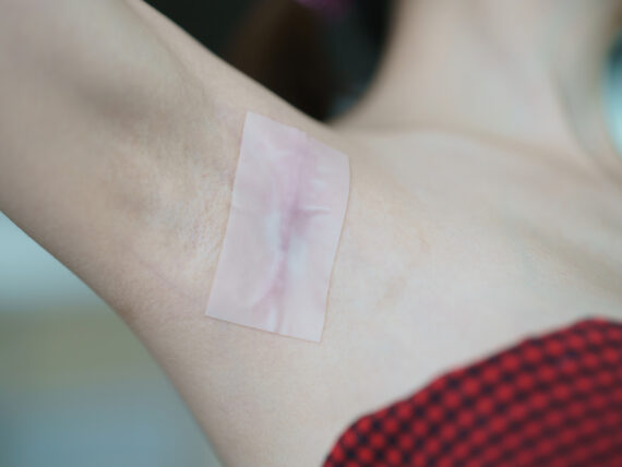 Reduce the Appearance of Keloid without Surgery | Miami, FL