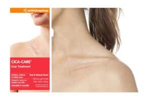 Top 8 Most Effective Keloid Scar Removal Creams