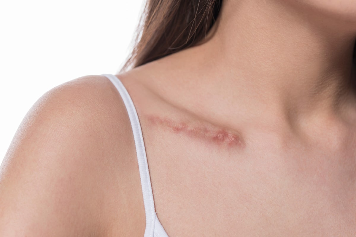 Cost Analysis: Laser vs Surgical Keloid Scar Treatment