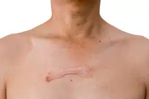 Effective Strategies for Chest Keloid Removal