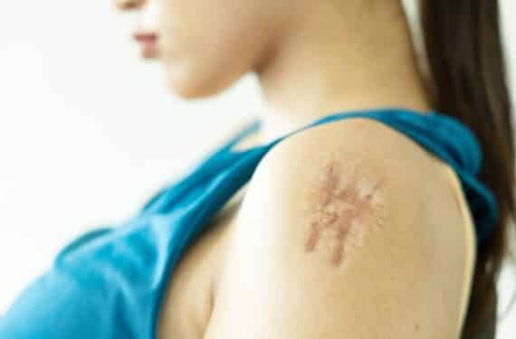Keloids vs Hypertrophic Scars: Key Differences Explained